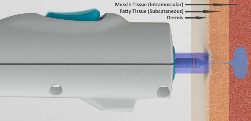 Needle-free injection tech to deliver UK’s COVID-19 vaccine