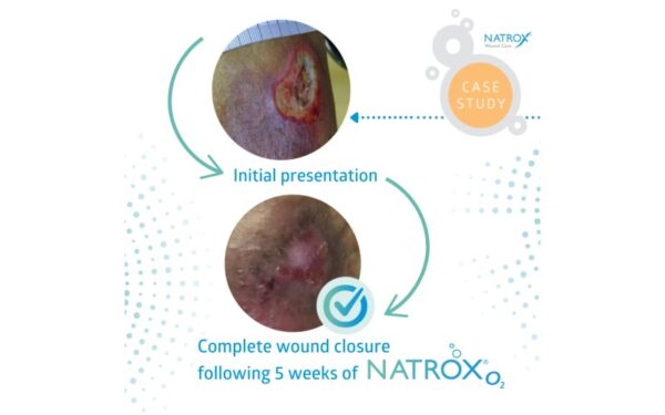 Inotec – NATROX® O₂ device heals wounds with humidified oxygen